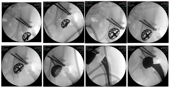 Femoral Head Autograft to Manage Acetabular Bone Loss Defects in THA ...