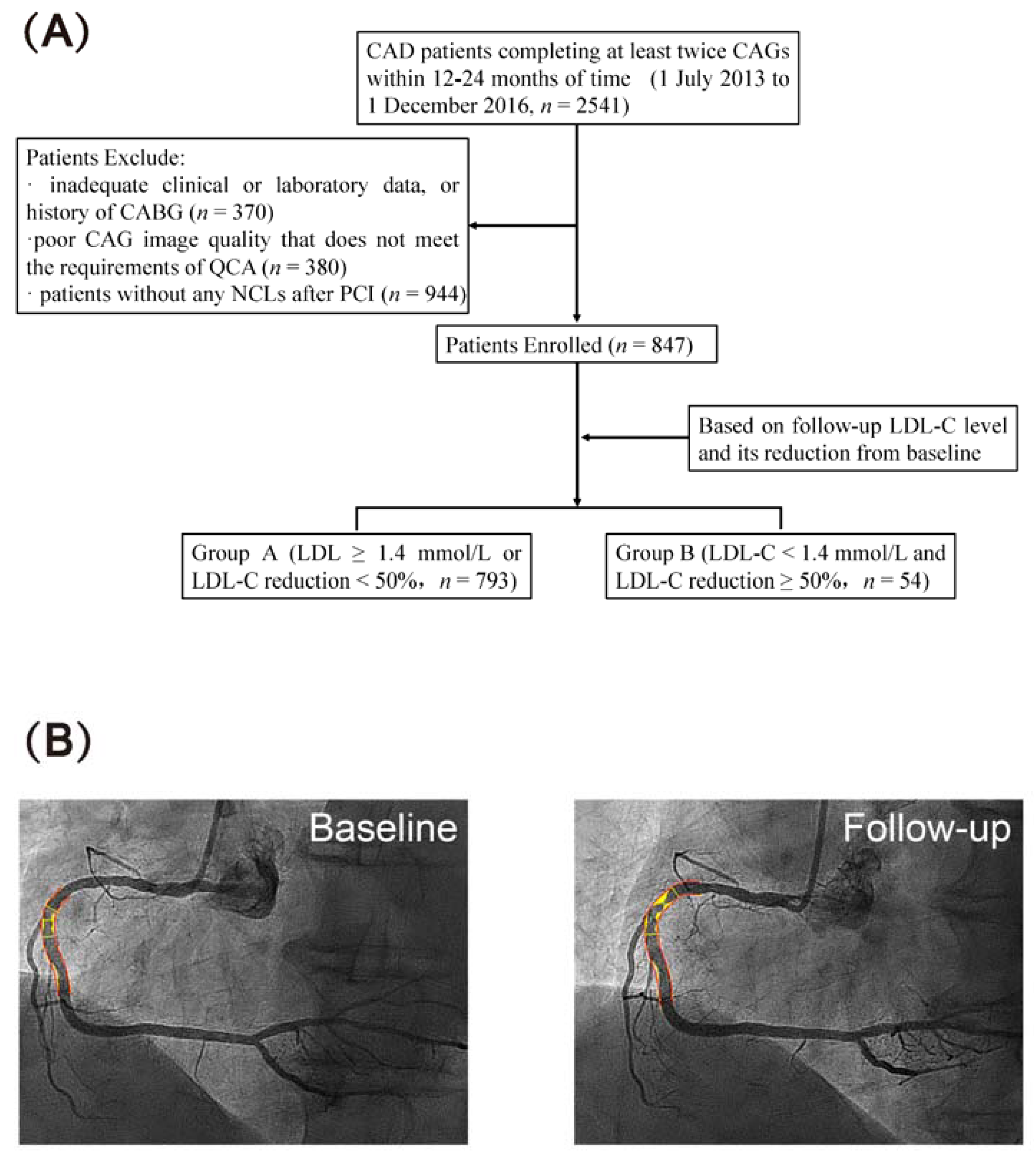 Influence of LDL-Cholesterol Lowering on Coronary Plaque Progression of ...