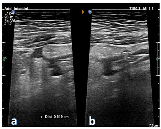 Gastrointestinal Ultrasound in Emergency Setting