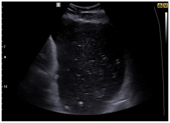 Gastrointestinal Ultrasound in Emergency Setting