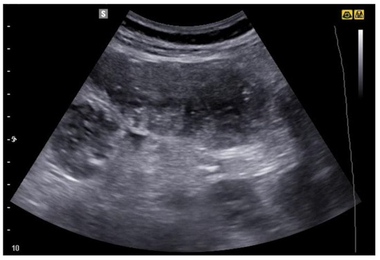 Gastrointestinal Ultrasound in Emergency Setting