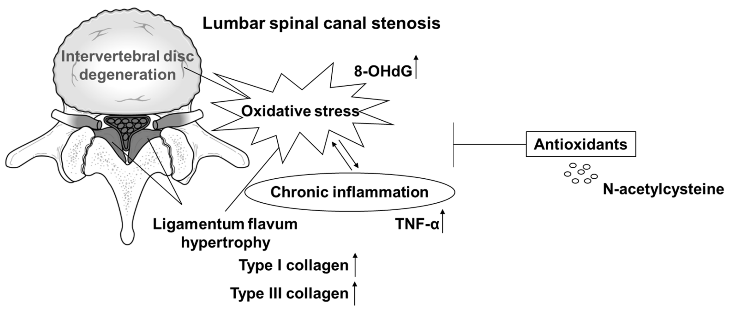 Ligamentum Hypertrophy