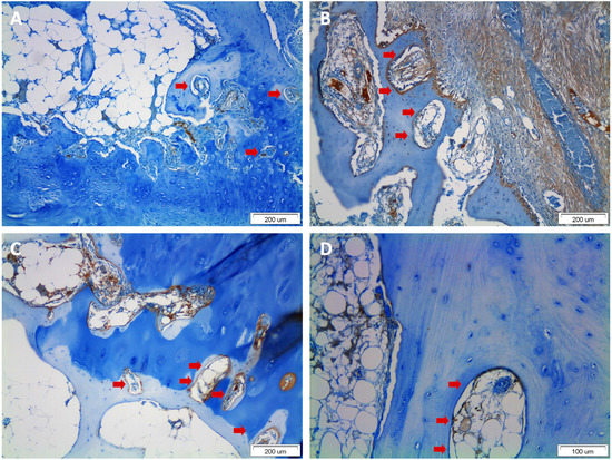 Subchondral Bone Cyst Development in Osteoarthritis: From ...