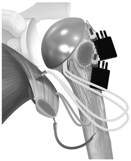 Lesser Tuberosity Osteotomy Healing in Stemmed and Stemless Anatomic ...