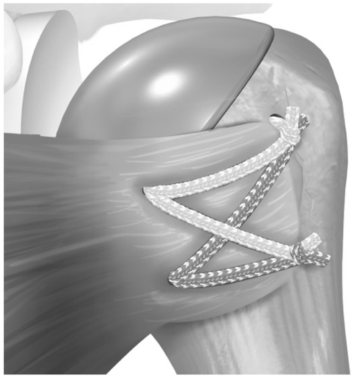 Lesser Tuberosity Osteotomy Healing in Stemmed and Stemless Anatomic ...