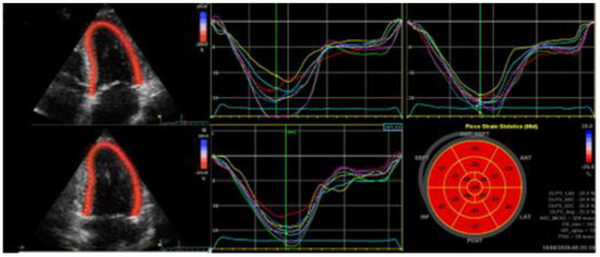 What Strain Analysis Adds to Diagnosis and Prognosis in Heart Failure ...