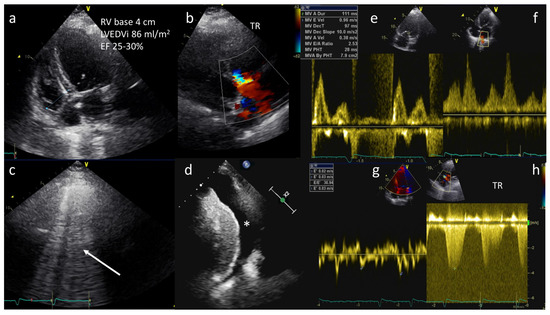 Acute Heart Failure: Diagnostic–Therapeutic Pathways and Preventive ...
