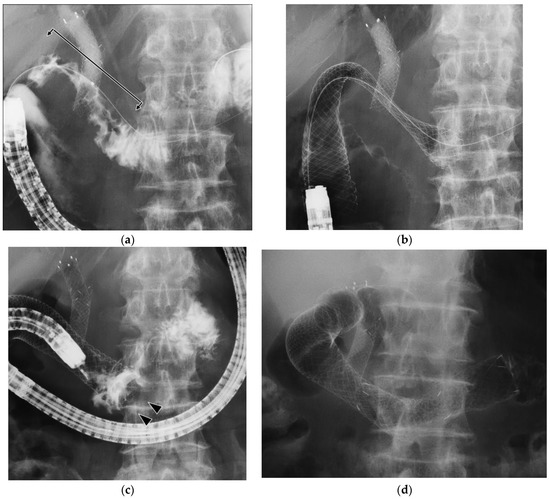Gastroduodenal Stenting with a Flexible Stent Demonstrates Favorable ...
