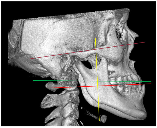 Locating the Mandibular Lingula Using Cone-Beam Computed Tomography: A ...