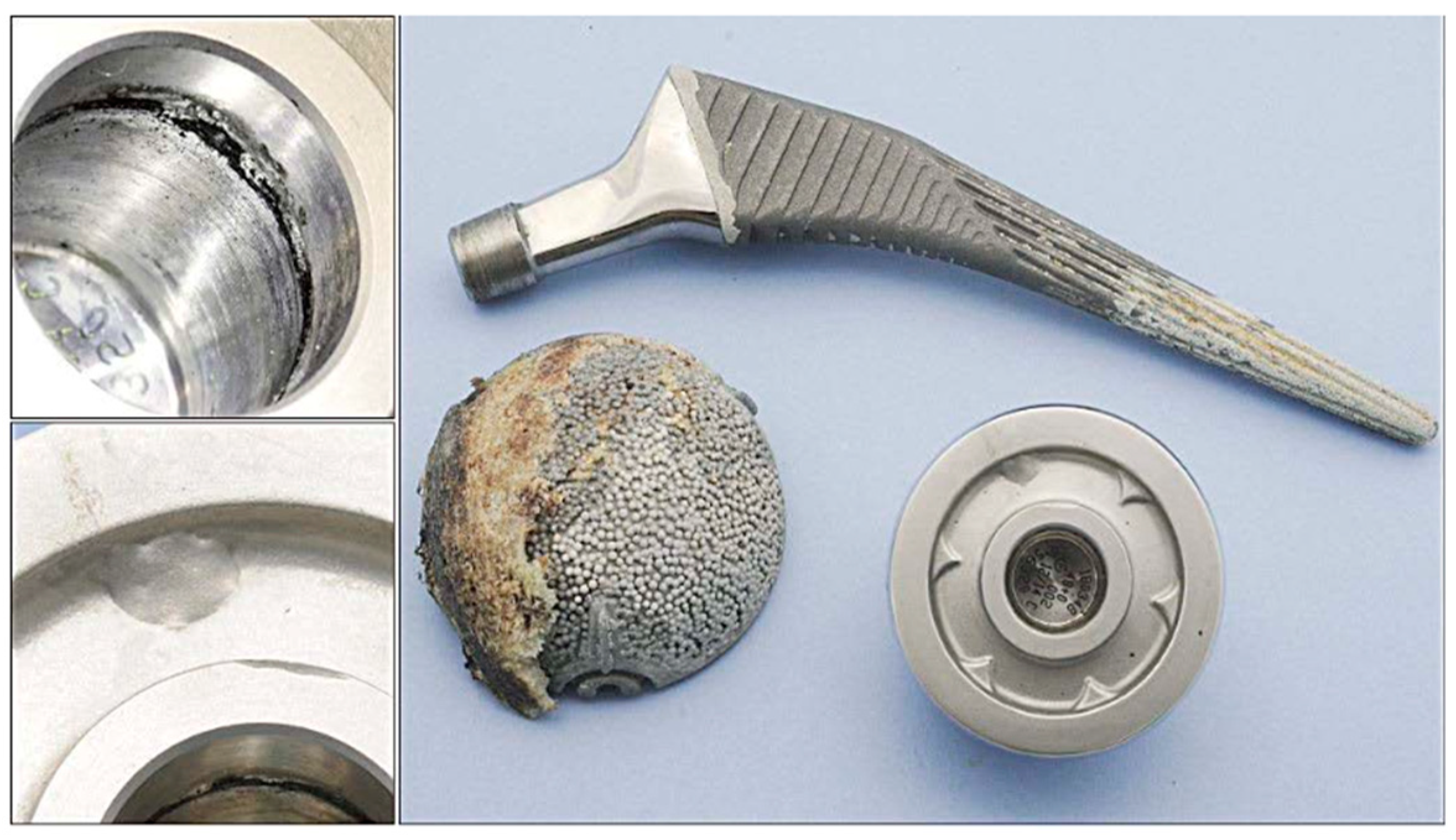 JCM | Free Full-Text | Metal-on-Metal Hips: Ten-Year Clinical and ...