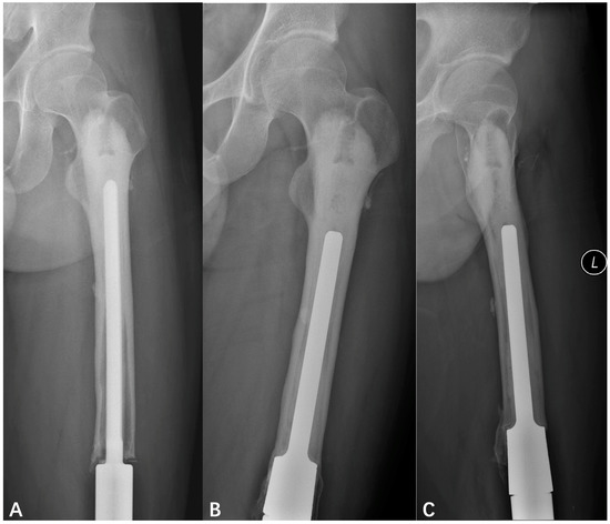 GMRS Oncological Prosthesis with a Porous Coating Collar: A Good Option ...