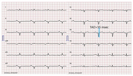 A Novel Heterozygous Desmoplakin Variant Causes Cardiocutaneous ...