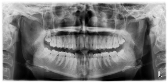 Jacob’s Disease: Case Series, Extensive Literature Review and ...