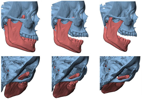 Jacob’s Disease: Case Series, Extensive Literature Review and ...