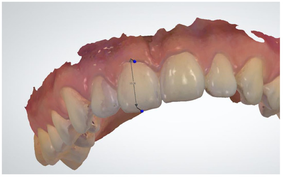 A Comparison of Teeth Measurements on Plaster and Digital Models