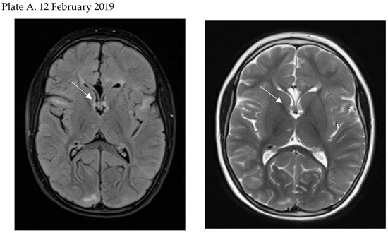 Subependymal Giant Cell Astrocytomas in Tuberous Sclerosis Complex ...