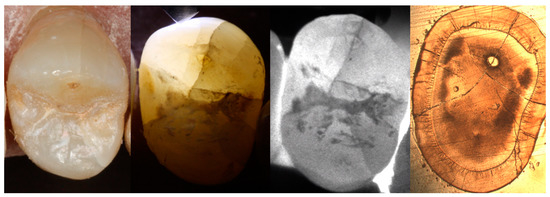 Three Visual–Diagnostic Methods for the Detection of Enamel Cracks: An ...