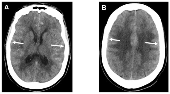 Pathophysiology of Early Brain Injury and Its Association with Delayed ...