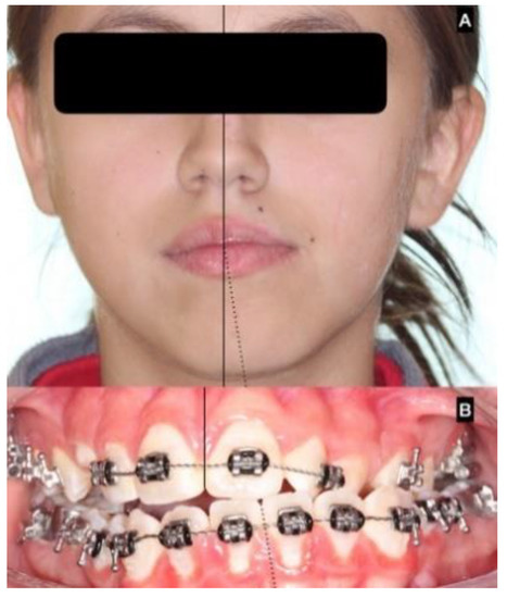 Diagnosis and Treatment in Unilateral Condylar Hyperplasia