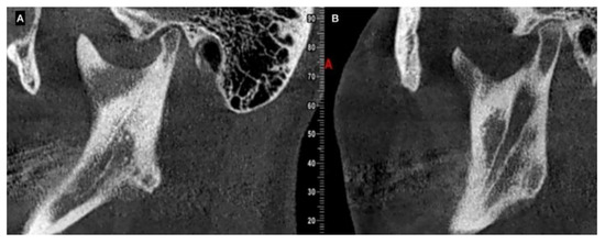 Diagnosis and Treatment in Unilateral Condylar Hyperplasia