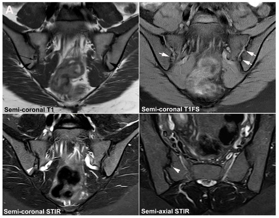 JCM | Free Full-Text | Diagnostics of Sacroiliac Joint Differentials to ...
