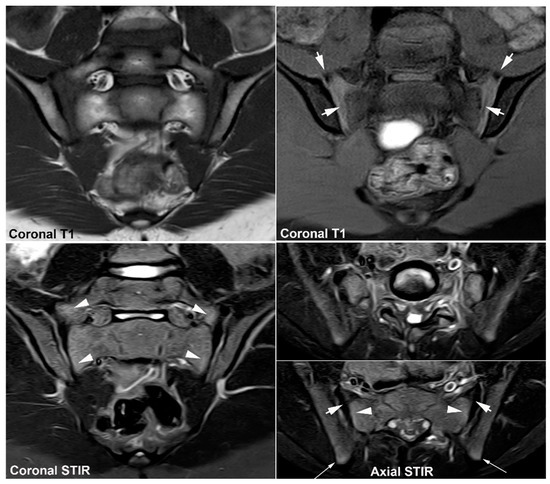 JCM | Free Full-Text | Diagnostics of Sacroiliac Joint Differentials to Axial Spondyloarthritis ...