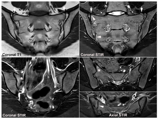 JCM | Free Full-Text | Diagnostics of Sacroiliac Joint Differentials to ...