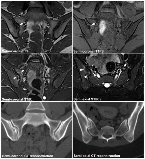 Diagnostics of Sacroiliac Joint Differentials to Axial ...