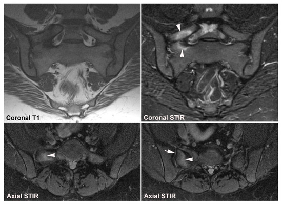 Diagnostics of Sacroiliac Joint Differentials to Axial ...