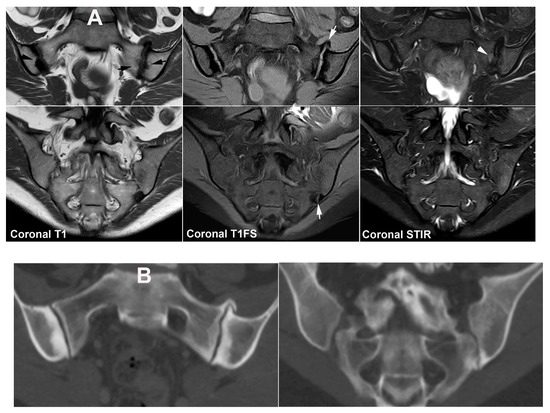 JCM | Free Full-Text | Diagnostics of Sacroiliac Joint Differentials to ...
