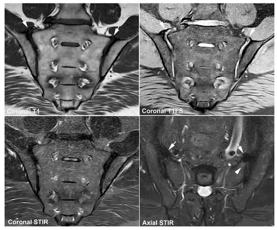 Diagnostics Of Sacroiliac Joint Differentials To Axial