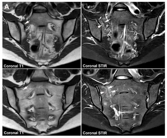JCM | Free Full-Text | Diagnostics of Sacroiliac Joint Differentials to ...