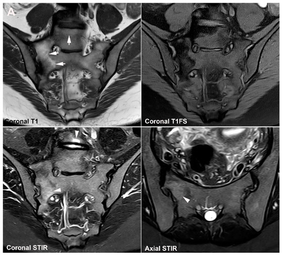 Diagnostics of Sacroiliac Joint Differentials to Axial ...