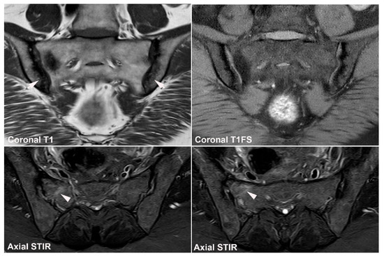 JCM | Free Full-Text | Diagnostics of Sacroiliac Joint Differentials to ...