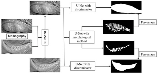 A Deep Learning Model for Evaluating Meibomian Glands Morphology from ...
