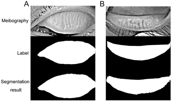 A Deep Learning Model for Evaluating Meibomian Glands Morphology from ...