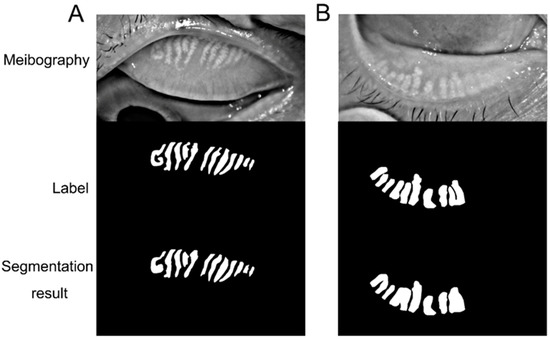 A Deep Learning Model for Evaluating Meibomian Glands Morphology from ...