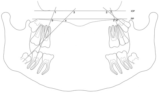 Eruption Pattern of Third Molars in Orthodontic Patients Treated with ...