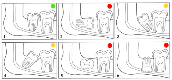 Eruption Pattern of Third Molars in Orthodontic Patients Treated with ...