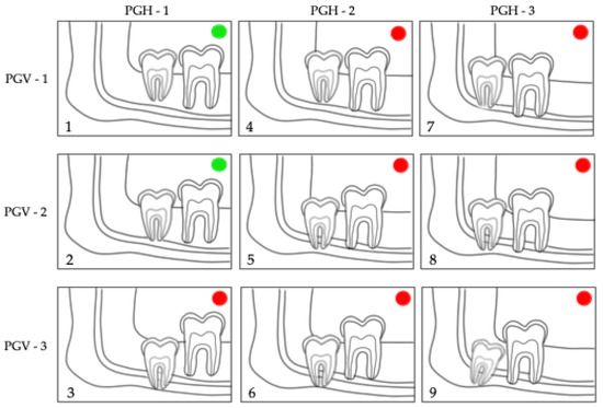 Eruption Pattern of Third Molars in Orthodontic Patients Treated with ...