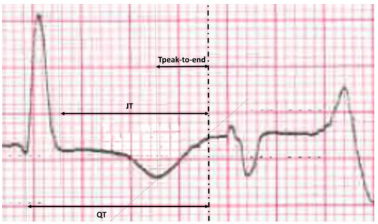 Prevalence and Clinical Characteristics of Patients with Torsades de ...