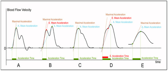Arterial Blood-Flow Acceleration Time on Doppler Ultrasound Waveforms ...
