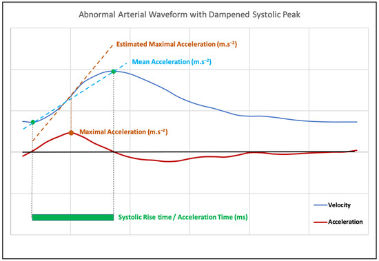 Arterial Blood-Flow Acceleration Time on Doppler Ultrasound Waveforms ...