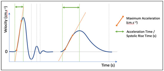 Arterial Blood-Flow Acceleration Time on Doppler Ultrasound Waveforms ...