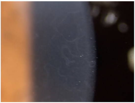 Epithelial Basement Membrane Dystrophy