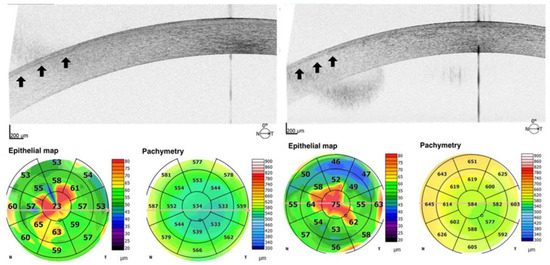 Acuity and Quality of Vision in Eyes with Epithelial Basement Membrane ...