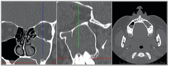 The Influence of Endodontic Lesions on The Clinical Evolution of ...