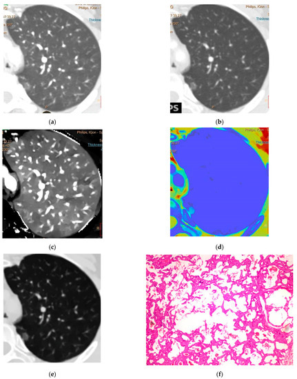 Spectral Dual-Layer Computed Tomography Can Predict the Invasiveness of Ground-Glass Nodules: A ...