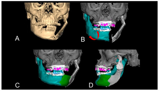 Towards Optimum Mandibular Reconstruction for Dental Occlusal ...