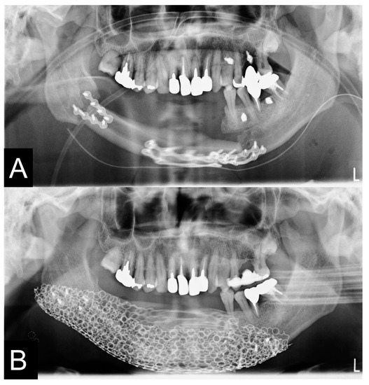 Towards Optimum Mandibular Reconstruction for Dental Occlusal ...